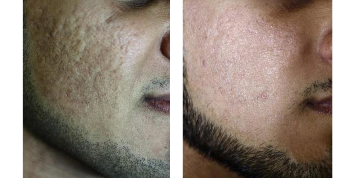 CO2RE Laser – Cloud 9 Medi Spa